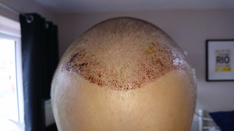 FUE Post-Op Pictures – Weeks 3 to 6 – Hair Transplant Story