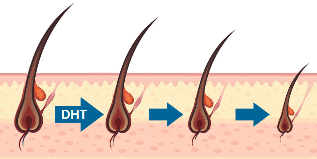 What Causes Hair Loss - DHT? - Hair Transplant Story
