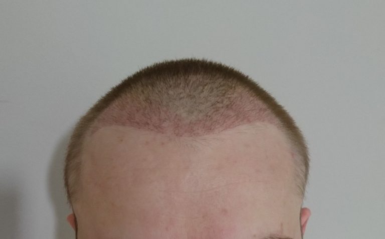 FUE Post-Op Pictures – Weeks 8 to 12 – Hair Transplant Story